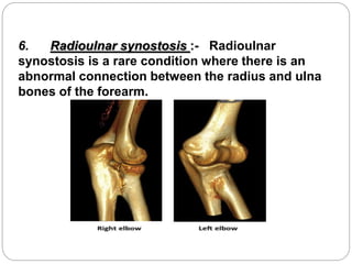 Abruzzo Ericson Syndrome | PPT