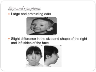 Abruzzo Ericson Syndrome | PPT