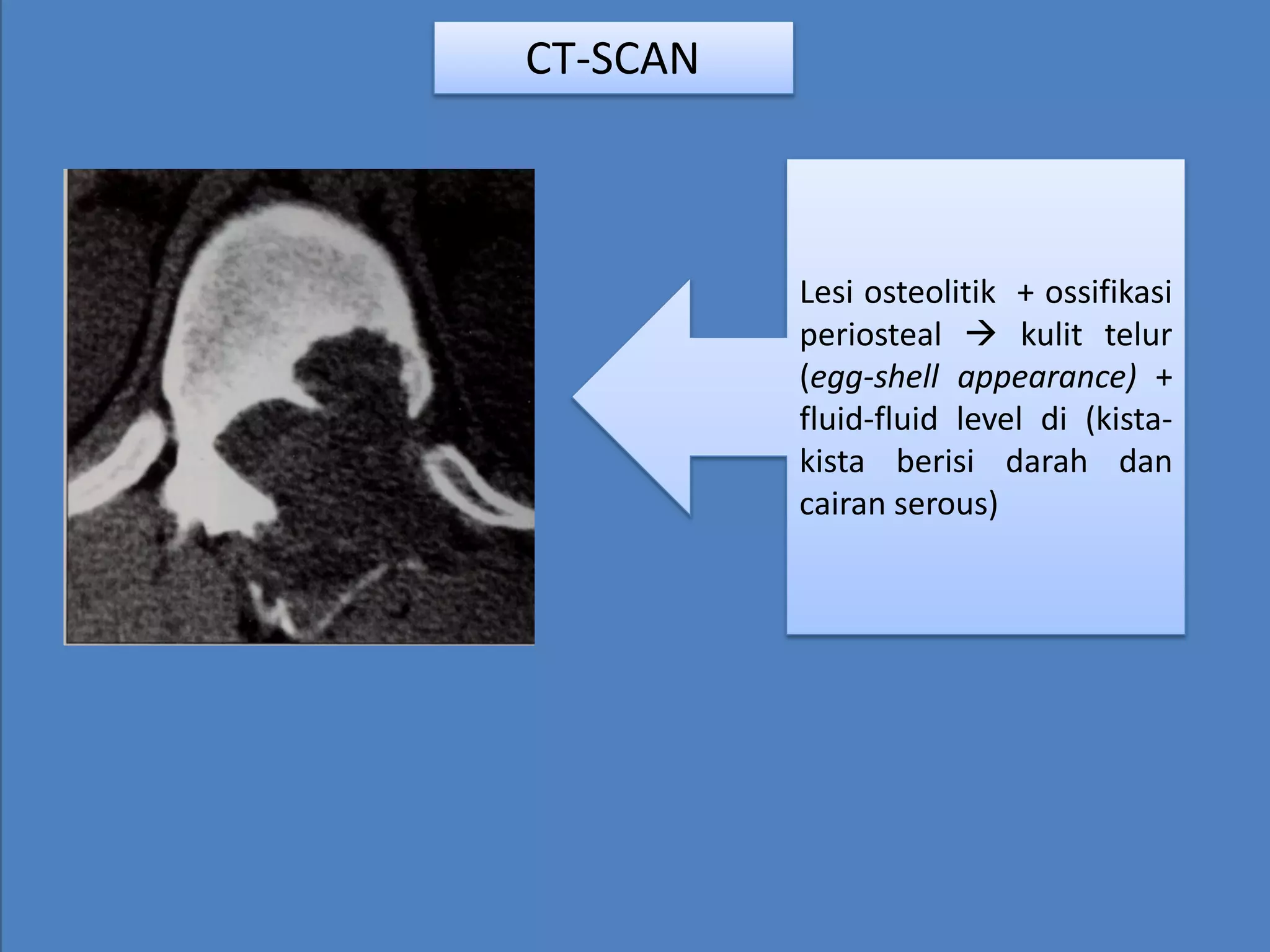 ABC (Aneurysmal Bone Cyst) - Rahmayanti Arief (PP).pdf
