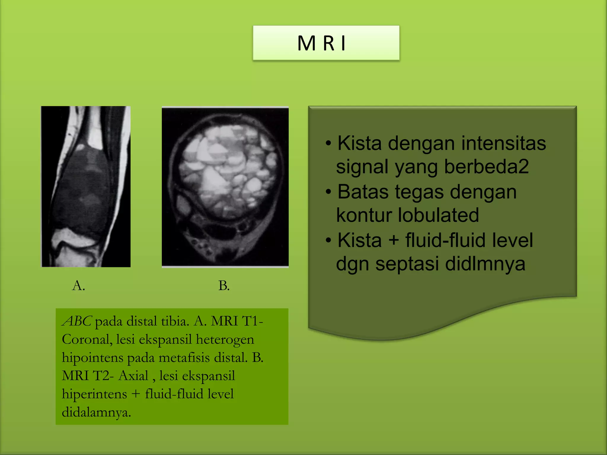 ABC (Aneurysmal Bone Cyst) - Rahmayanti Arief (PP).pdf