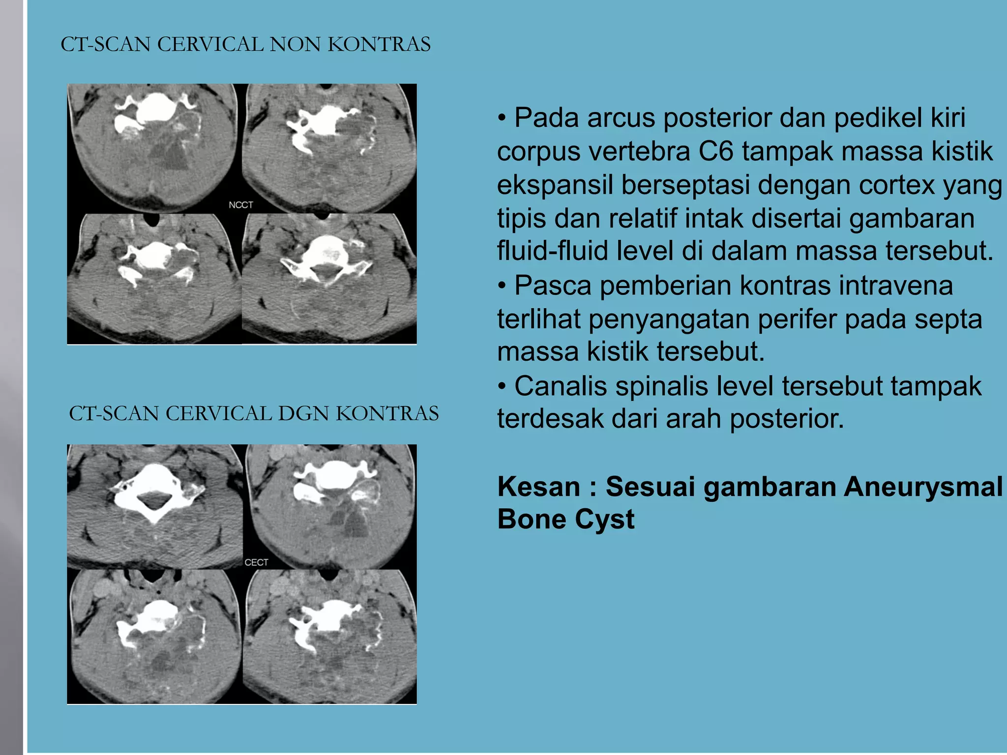 ABC (Aneurysmal Bone Cyst) - Rahmayanti Arief (PP).pdf