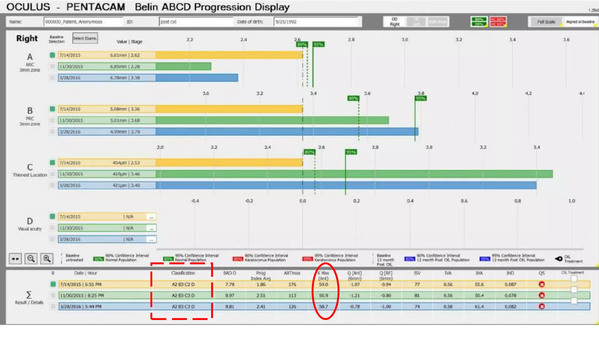 Keratoconus: ABCD classification | PPT