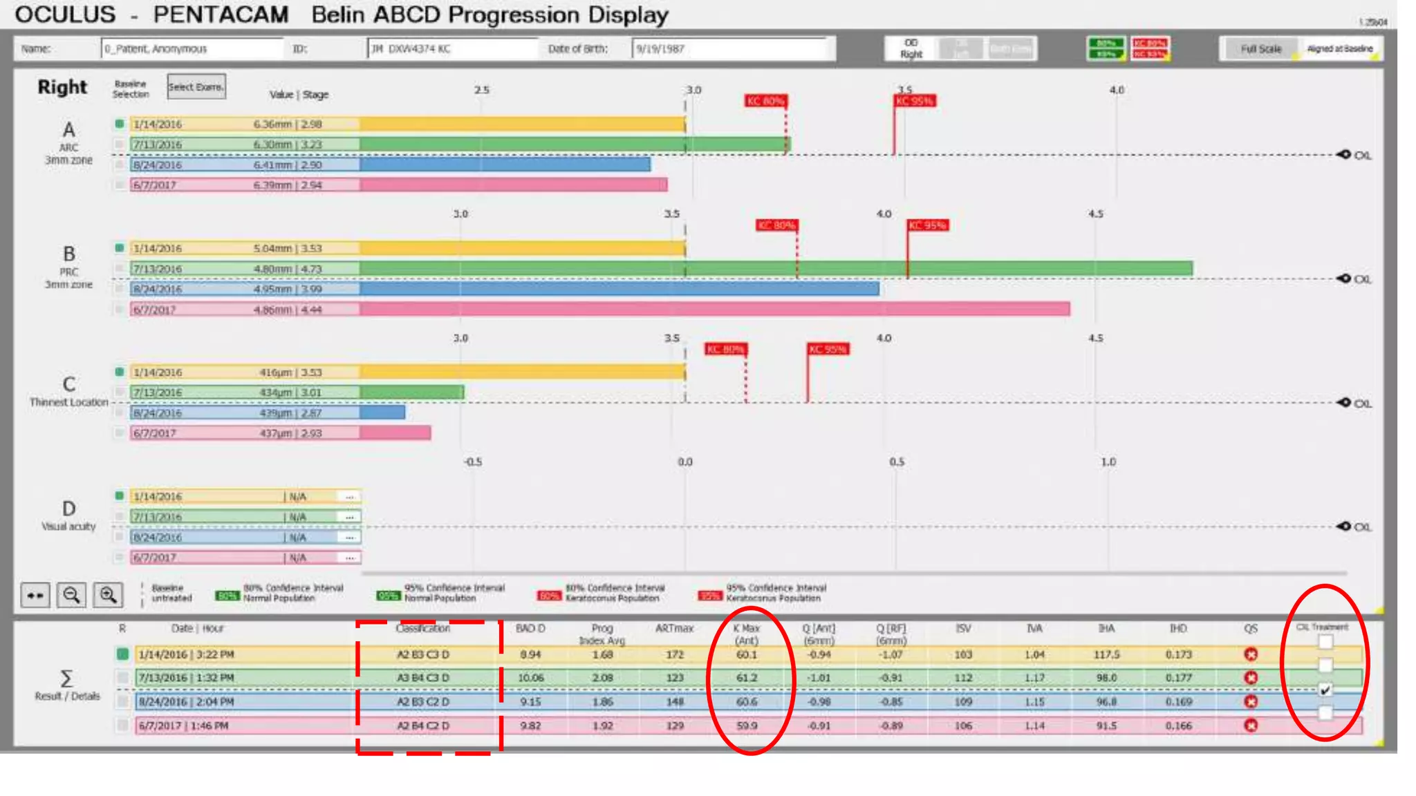 Keratoconus: ABCD classification | PPTX