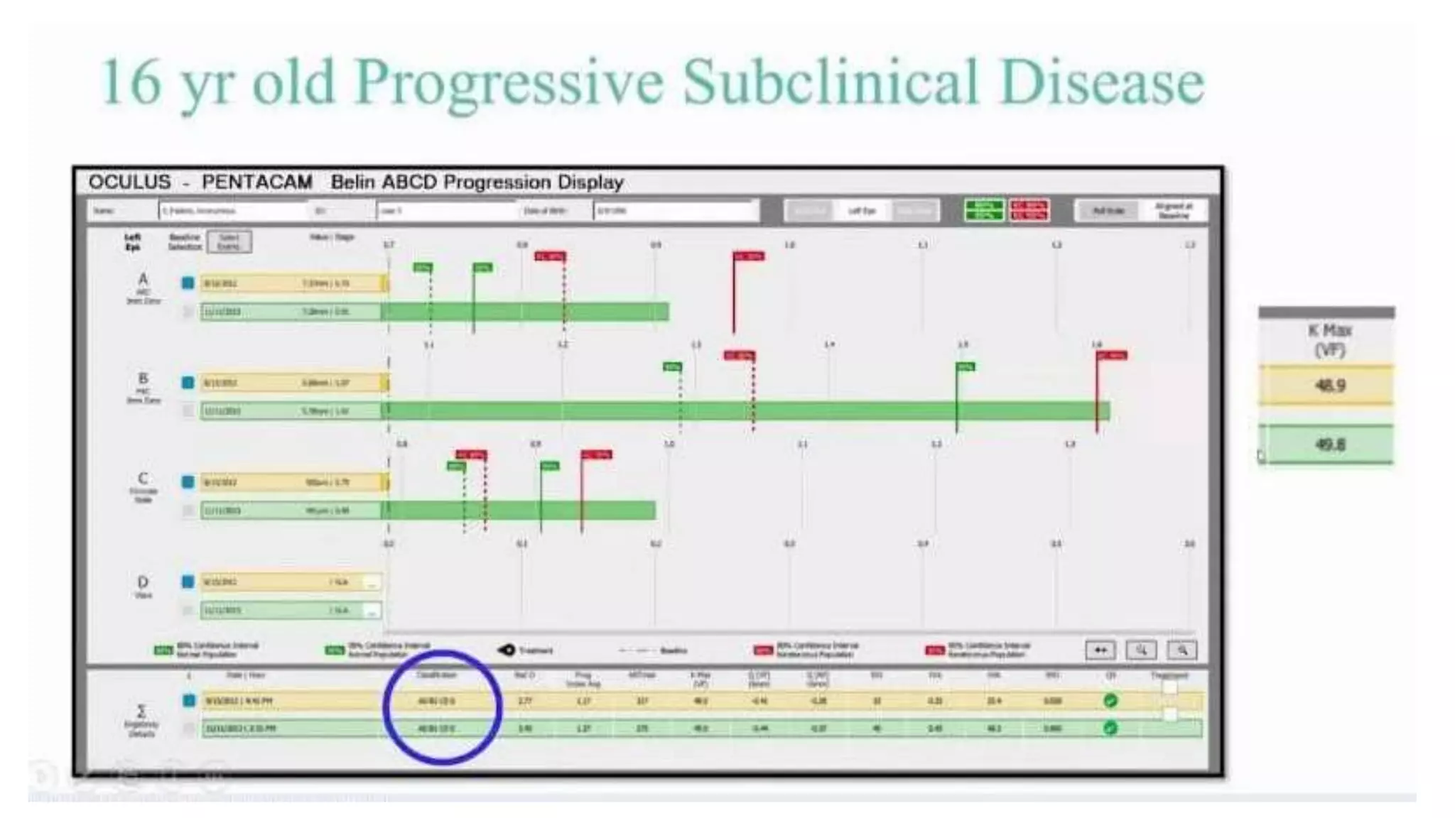 Keratoconus: ABCD classification | PPTX