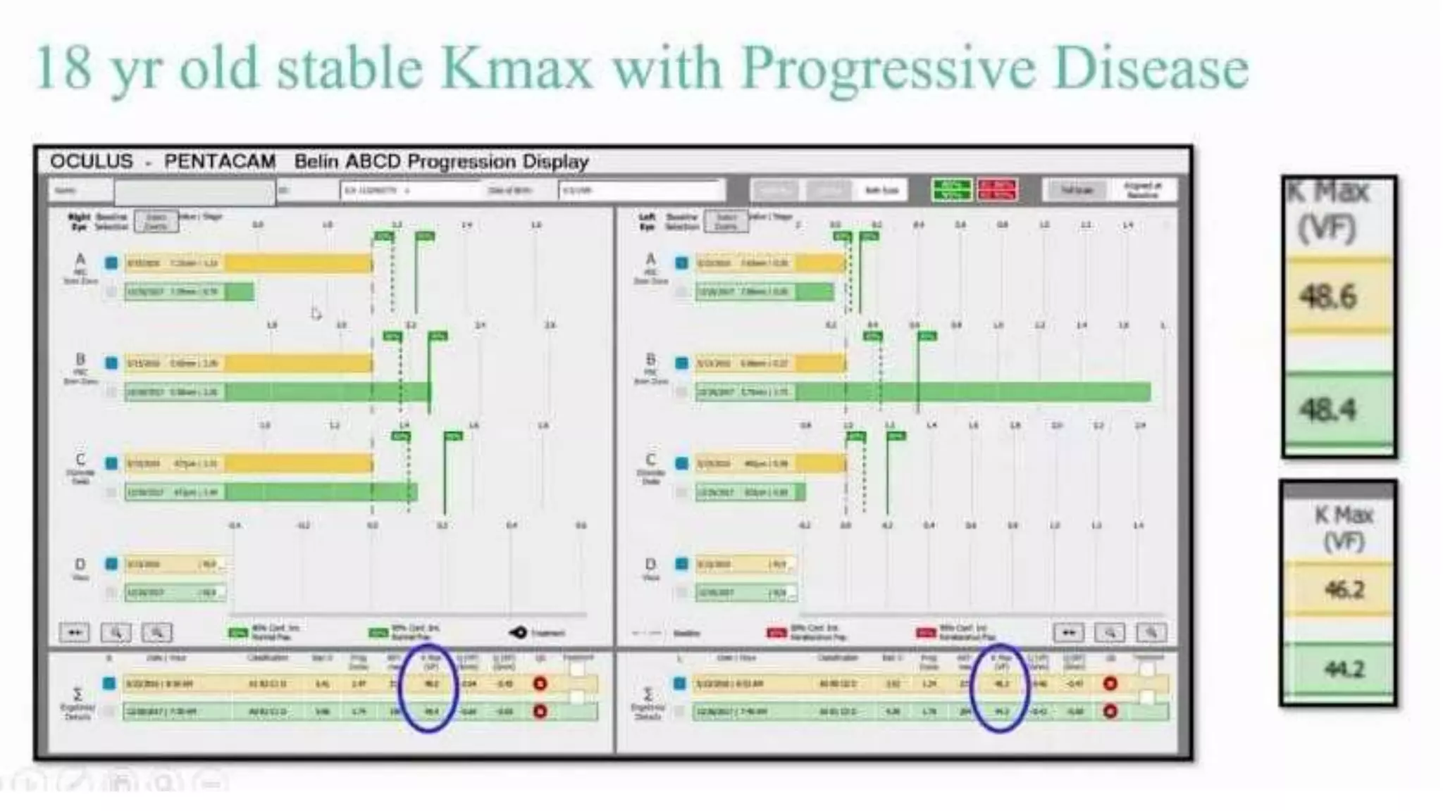 Keratoconus: ABCD classification | PPTX