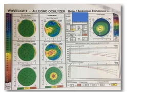 Keratoconus: ABCD classification | PPT