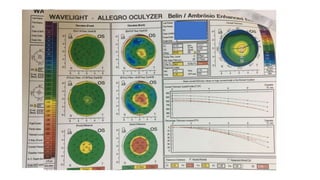Keratoconus: ABCD classification | PPT
