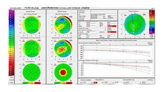 Keratoconus: ABCD classification | PPT