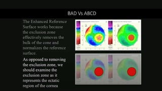 Keratoconus: ABCD classification | PPT