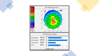 Keratoconus: ABCD classification | PPT