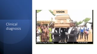 Keratoconus: ABCD classification | PPT