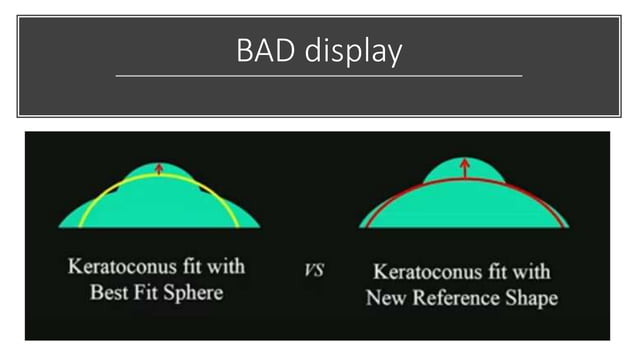 Abcd: A New Classification For Keratoconus – UPQUZQ