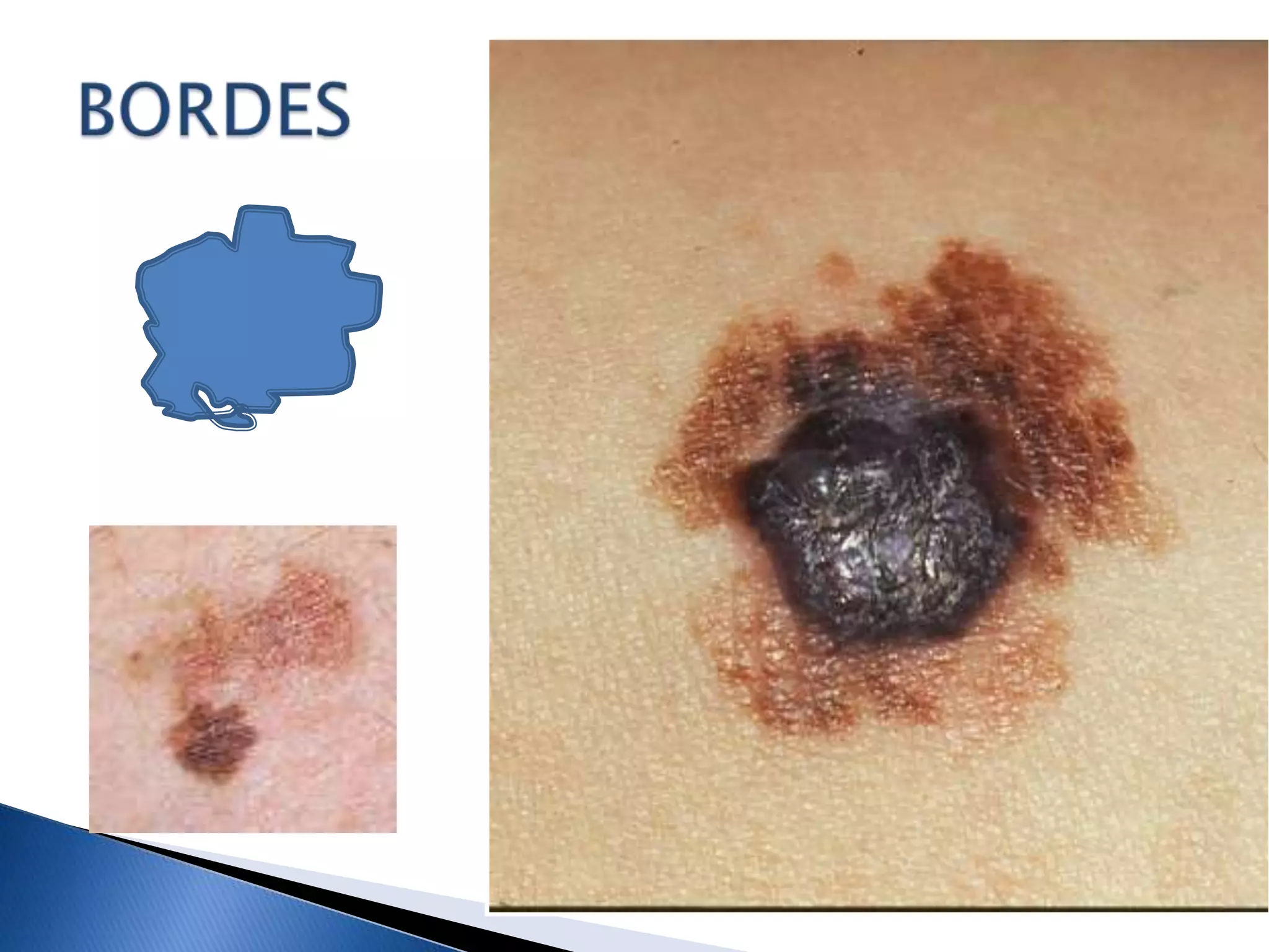 ABCDE del melanoma Tipos clinicos | PPTX