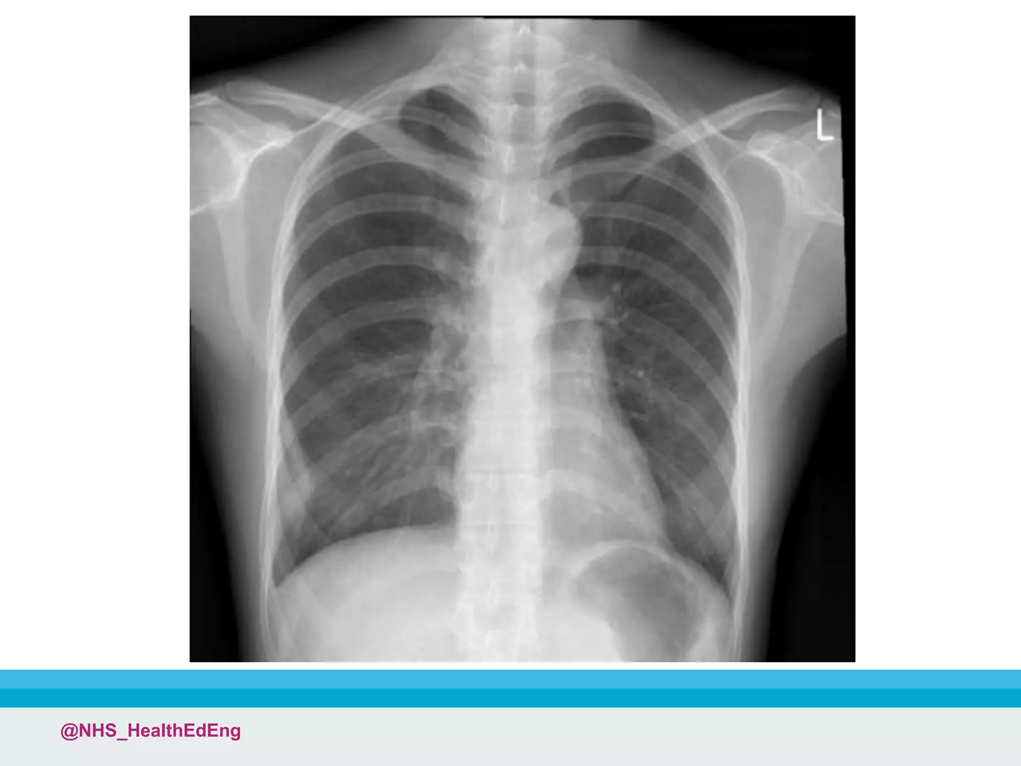 ABCDE CXR Final Version.pptx
