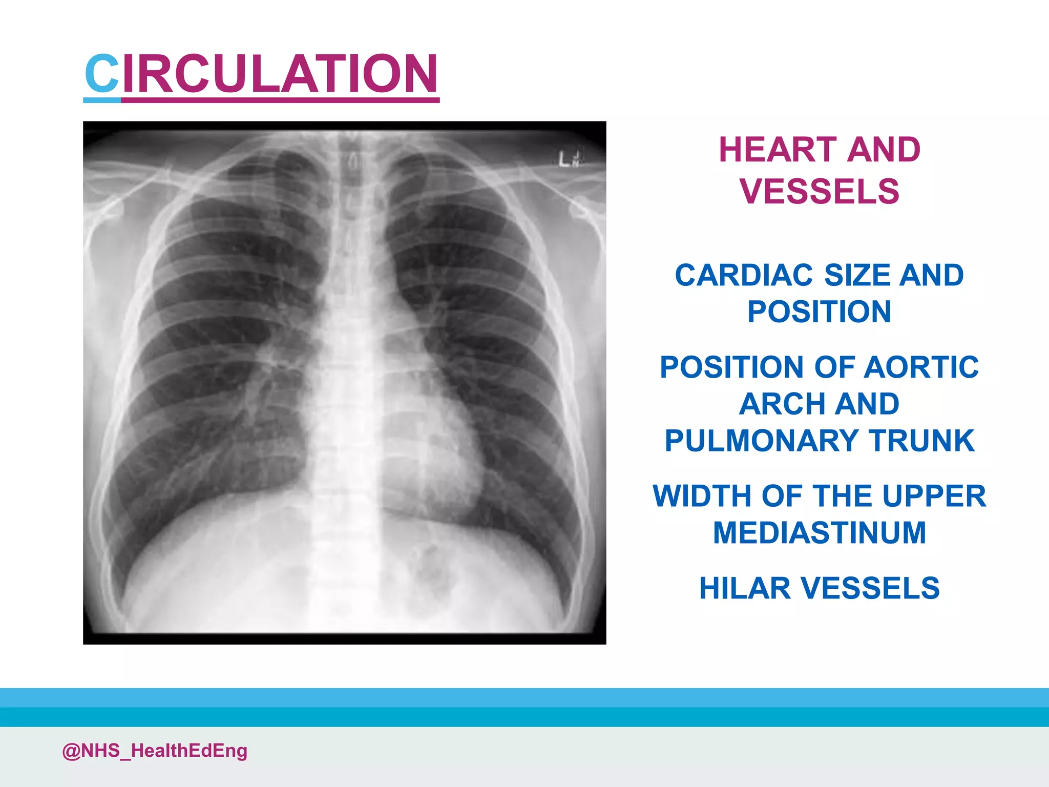 ABCDE CXR Final Version.pptx