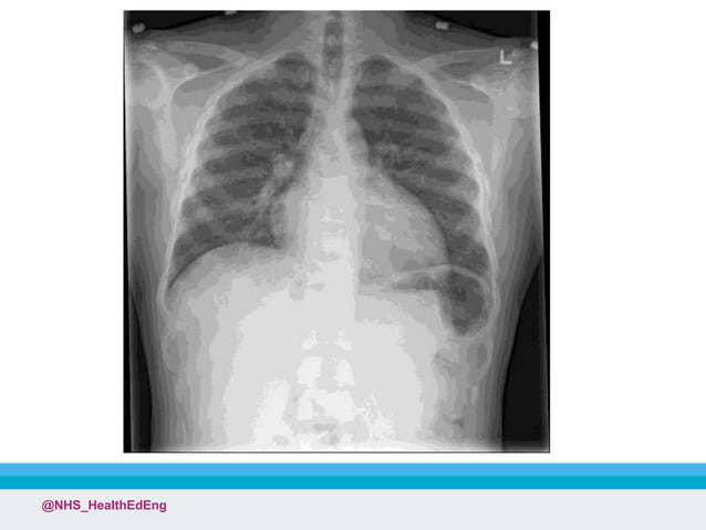 ABCDE CXR Final Version.pptx | Lung and Respiratory Health | Diseases ...