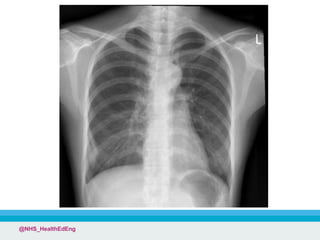 ABCDE CXR Final Version.pptx