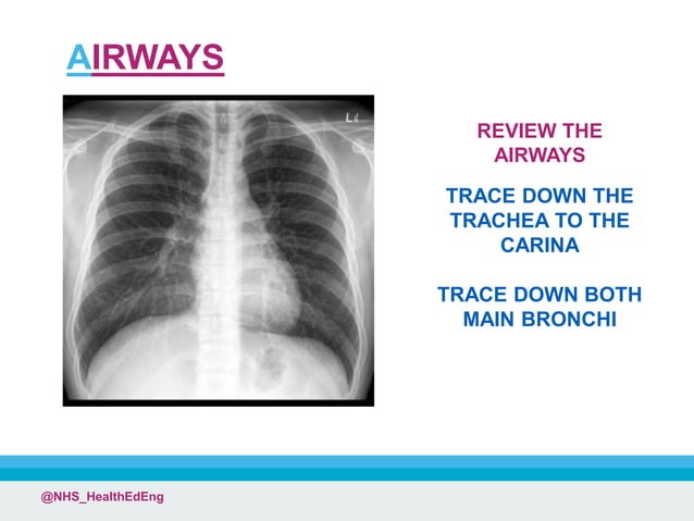 ABCDE CXR Final Version.pptx | Lung and Respiratory Health | Diseases ...