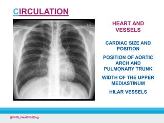 ABCDE CXR Final Version.pptx