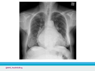 ABCDE CXR Final Version.pptx