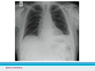 ABCDE CXR Final Version.pptx