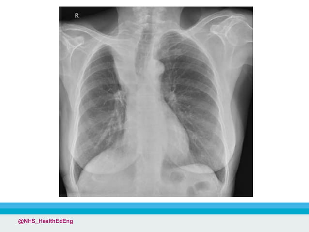 ABCDE CXR Final Version.pptx | Lung and Respiratory Health | Diseases ...
