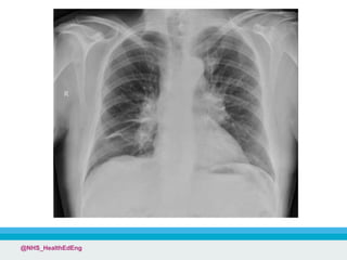 ABCDE CXR Final Version.pptx
