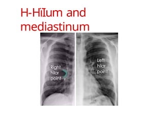 ABCDEFGH approach-- for chest X-Ray.pptx