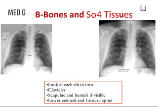ABCDEFGH approach-- for chest X-Ray.pptx
