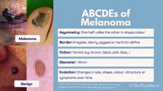 ABCDEs of Melanoma PowerPoint (OnTheWard.com) | PDF
