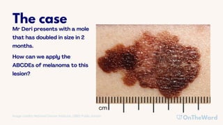ABCDEs of Melanoma PowerPoint (OnTheWard.com) | PDF