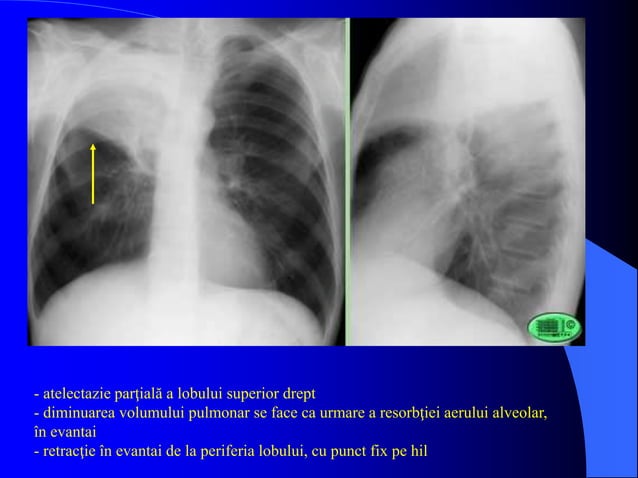 Abcese_pulmonare.ppt