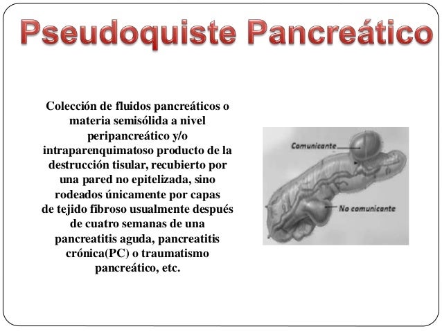 Abceso y Pseudoquiste Pancreático