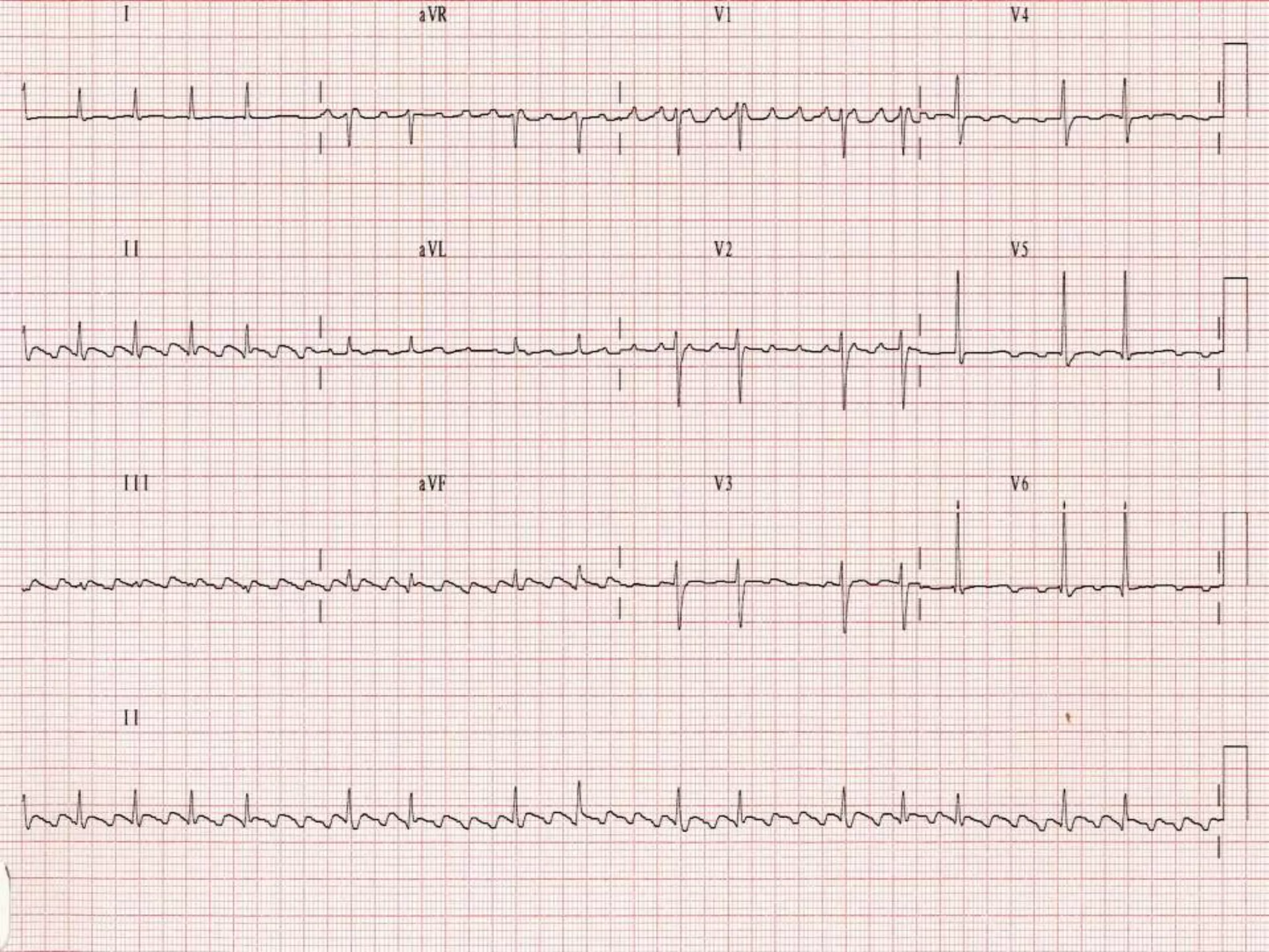 ABC of Electrocardiogram(ECG) | PPTX