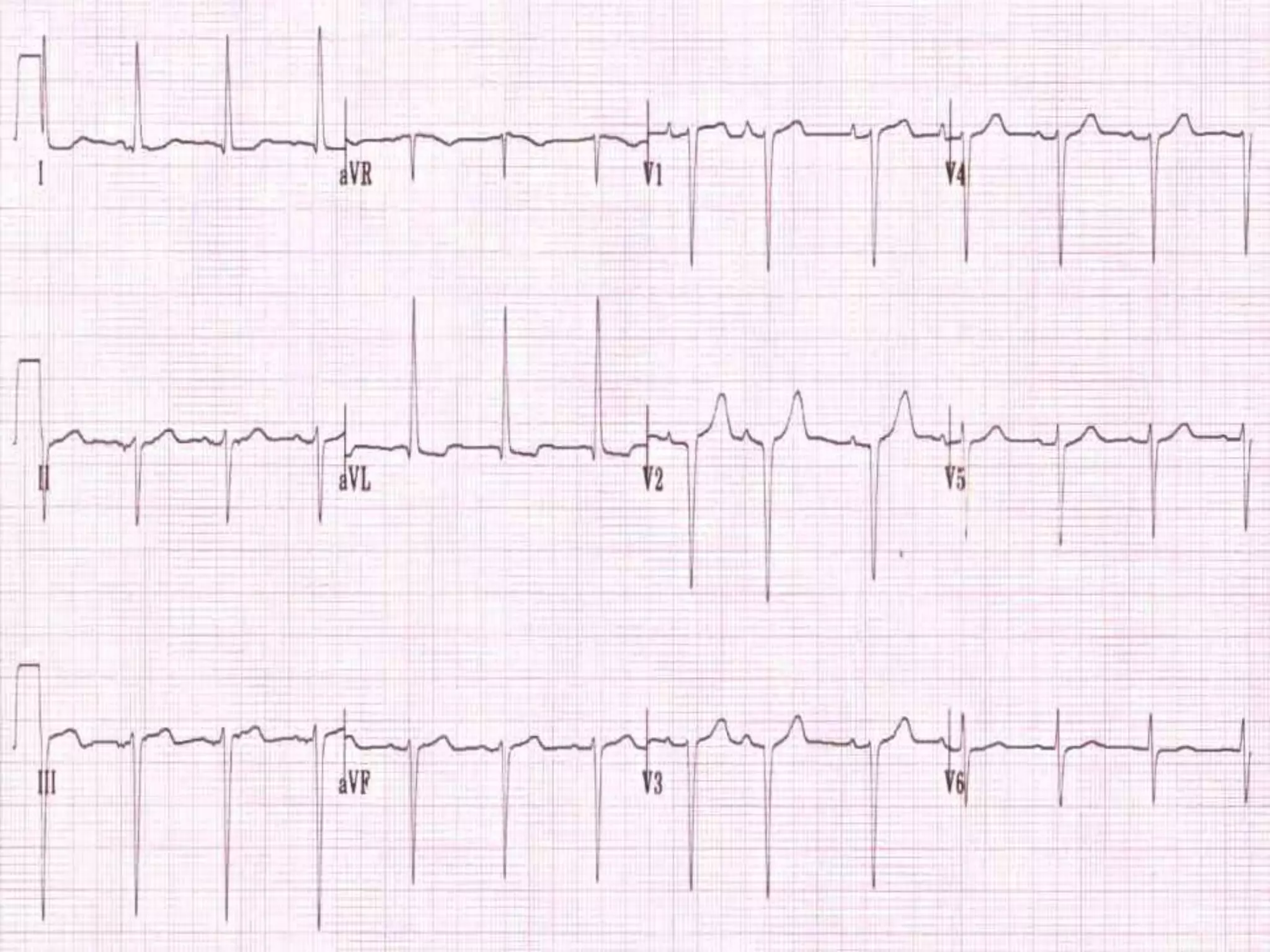ABC of Electrocardiogram(ECG) | PPTX