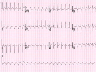 ABC of Electrocardiogram(ECG) | PPTX