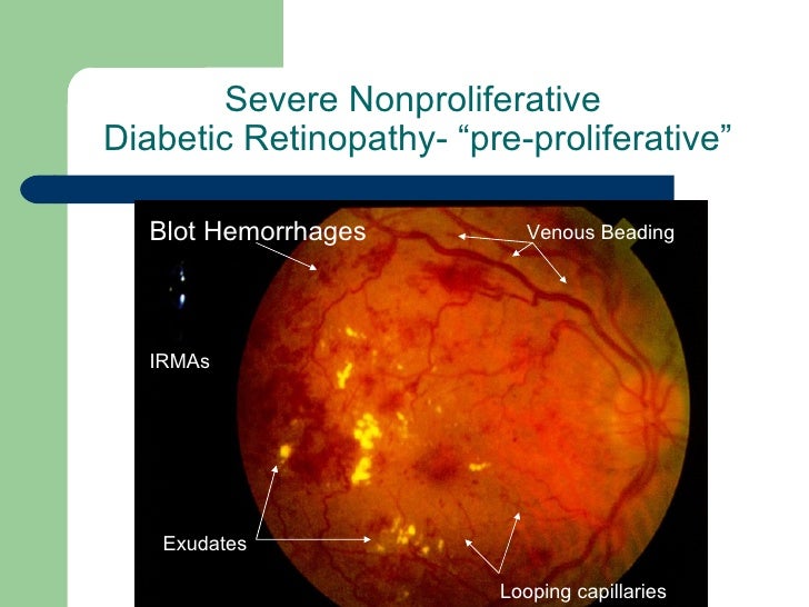 Diabetic eye disease