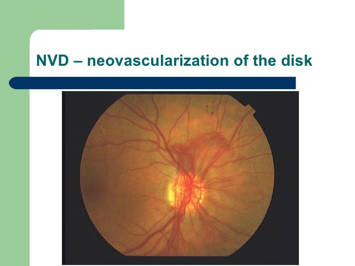 Diabetic eye disease