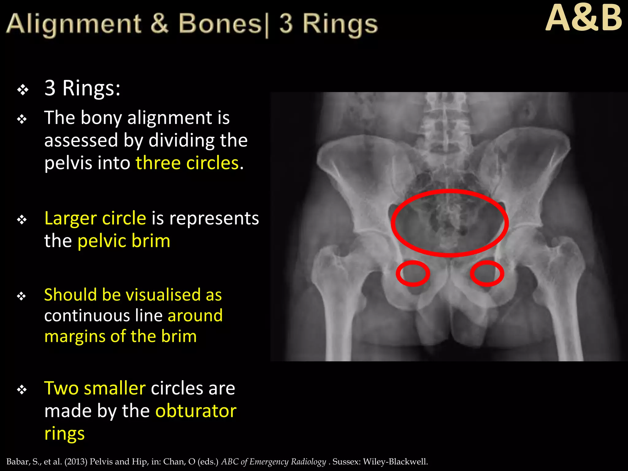 Trauma Image Interpretation of the Pelvis and Hip Radiographs: Using ...