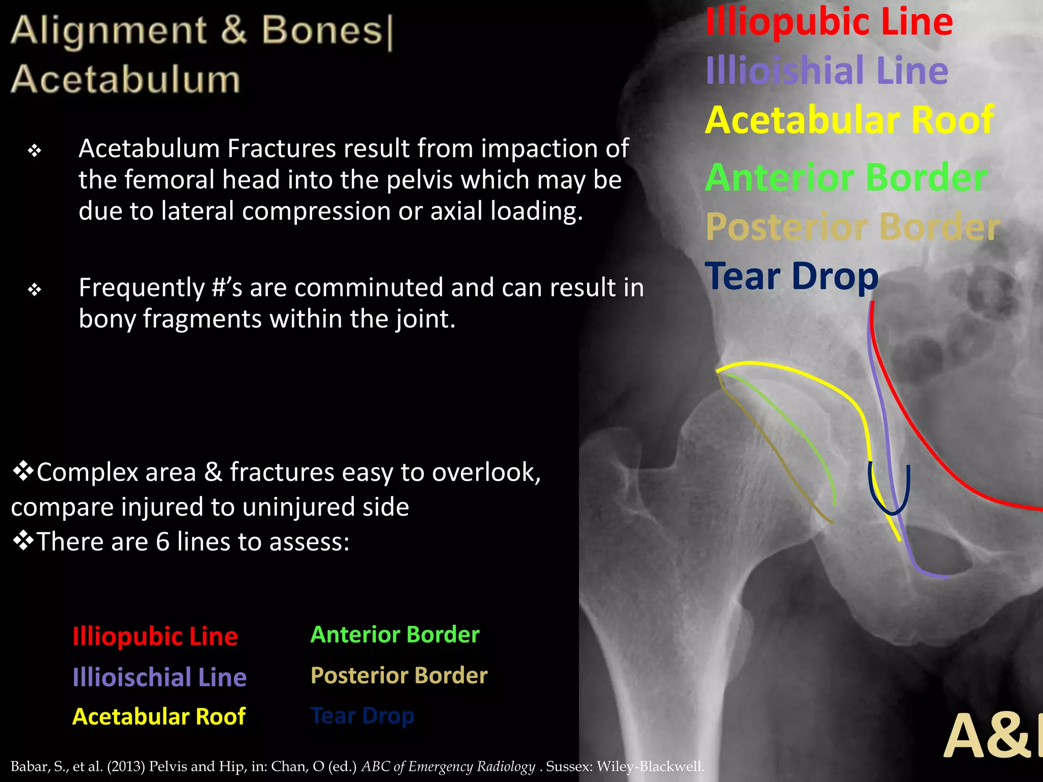 Trauma Image Interpretation of the Pelvis and Hip Radiographs: Using ...