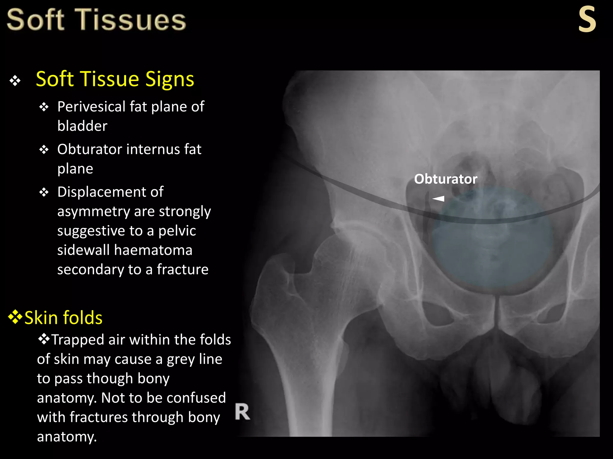 Trauma Image Interpretation of the Pelvis and Hip Radiographs: Using ...