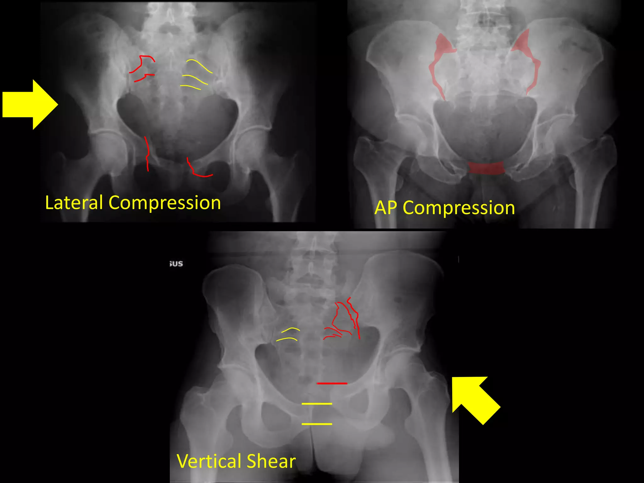 Trauma Image Interpretation of the Pelvis and Hip Radiographs: Using ...