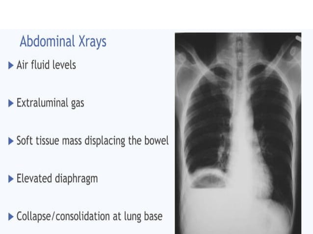 intra abdominal abscess and its management | PPTX