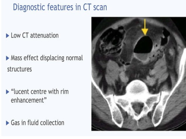 intra abdominal abscess and its management | PPTX