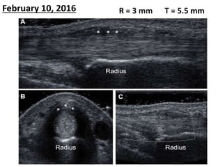 Case presentation ESRD 40th | PPT
