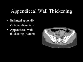 Abd ct appendicitis | PPT
