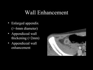 Abd ct appendicitis | PPT