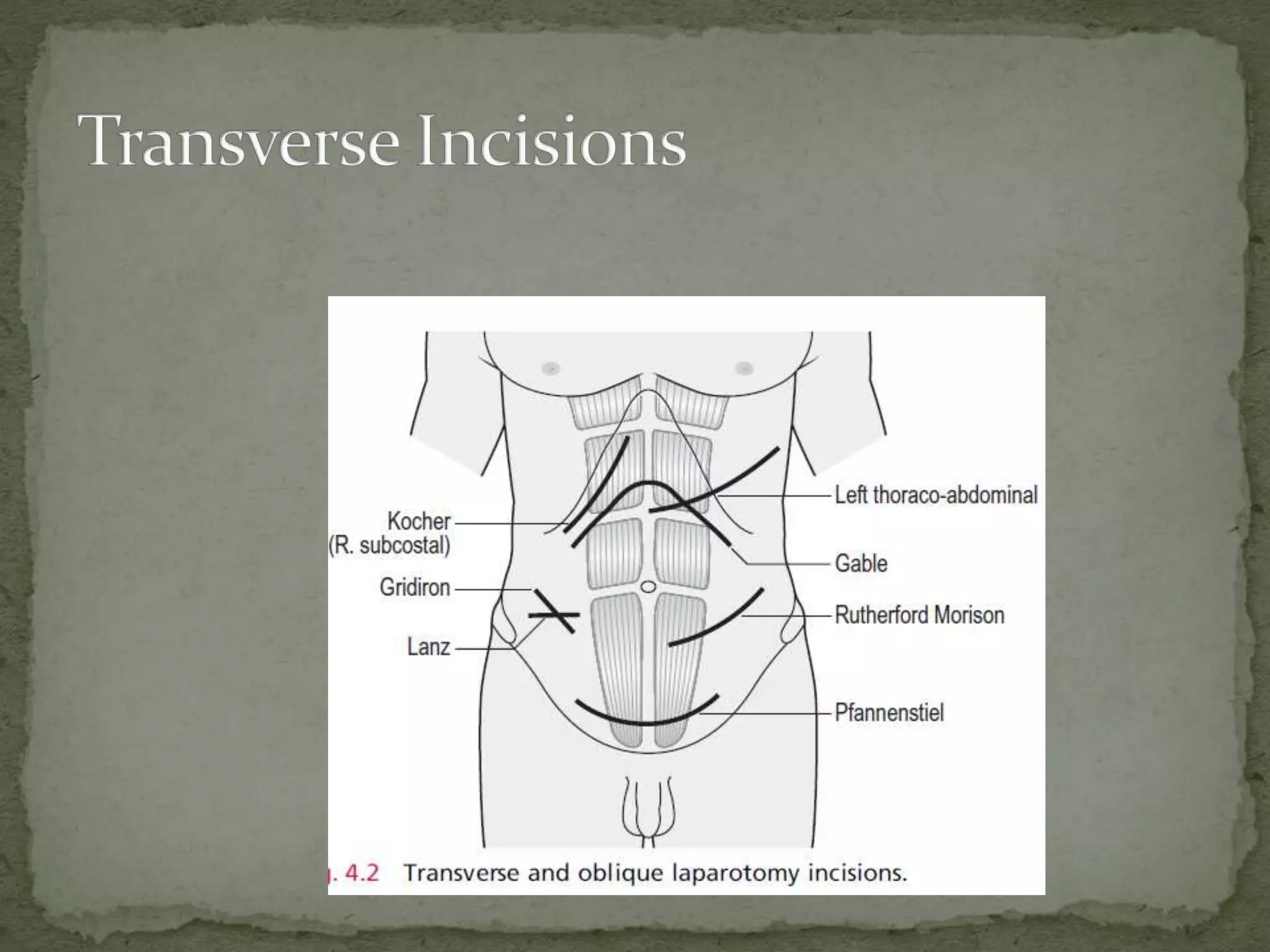 Abdomen layers & surgical incisions | PPTX