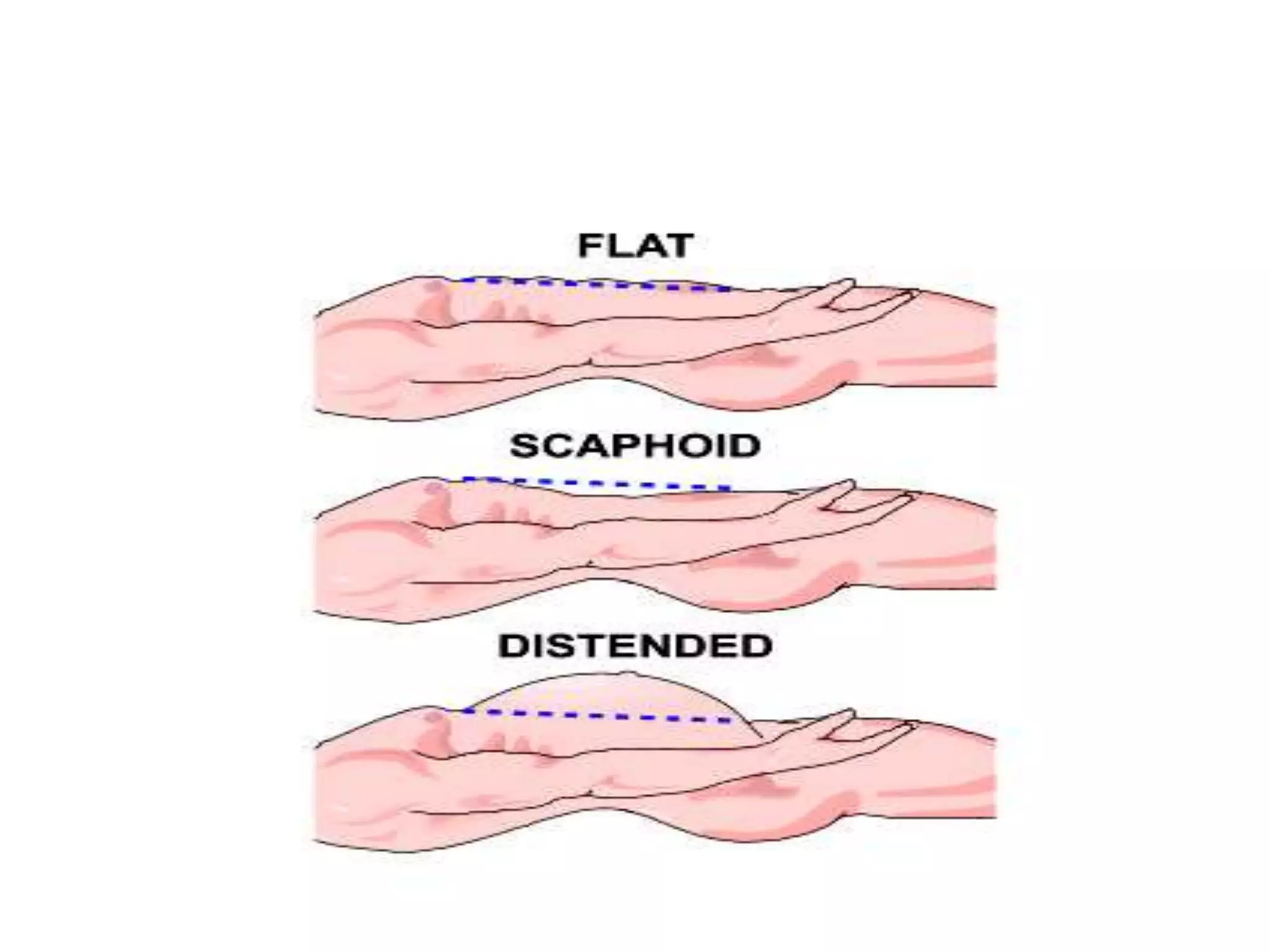 Abdominal Inspection | PPTX