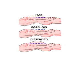 Scaphoid Shaped Abdomen